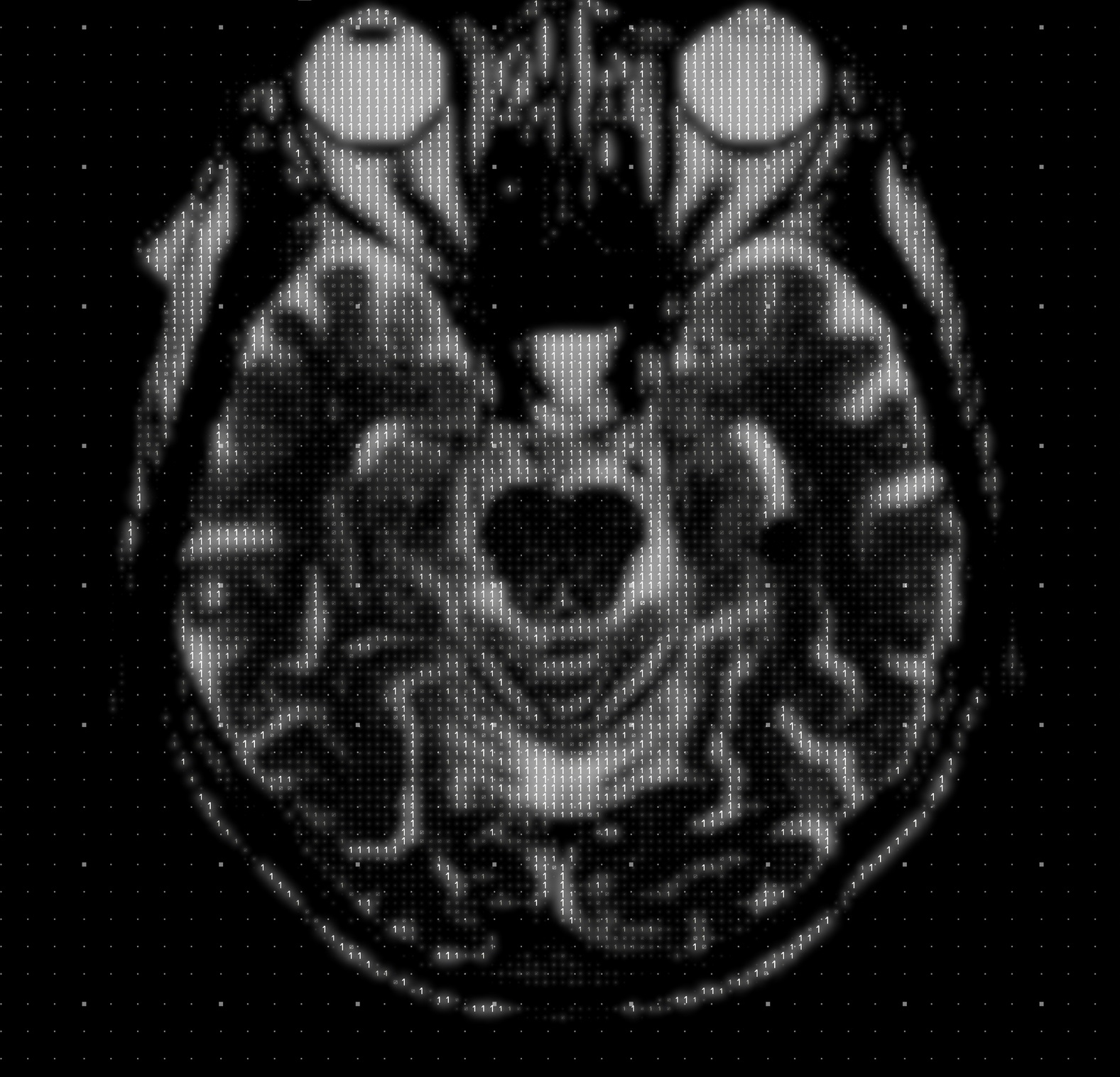 MRI-Guided Focused Ultrasound (FUS) to Treat Movement Disorders